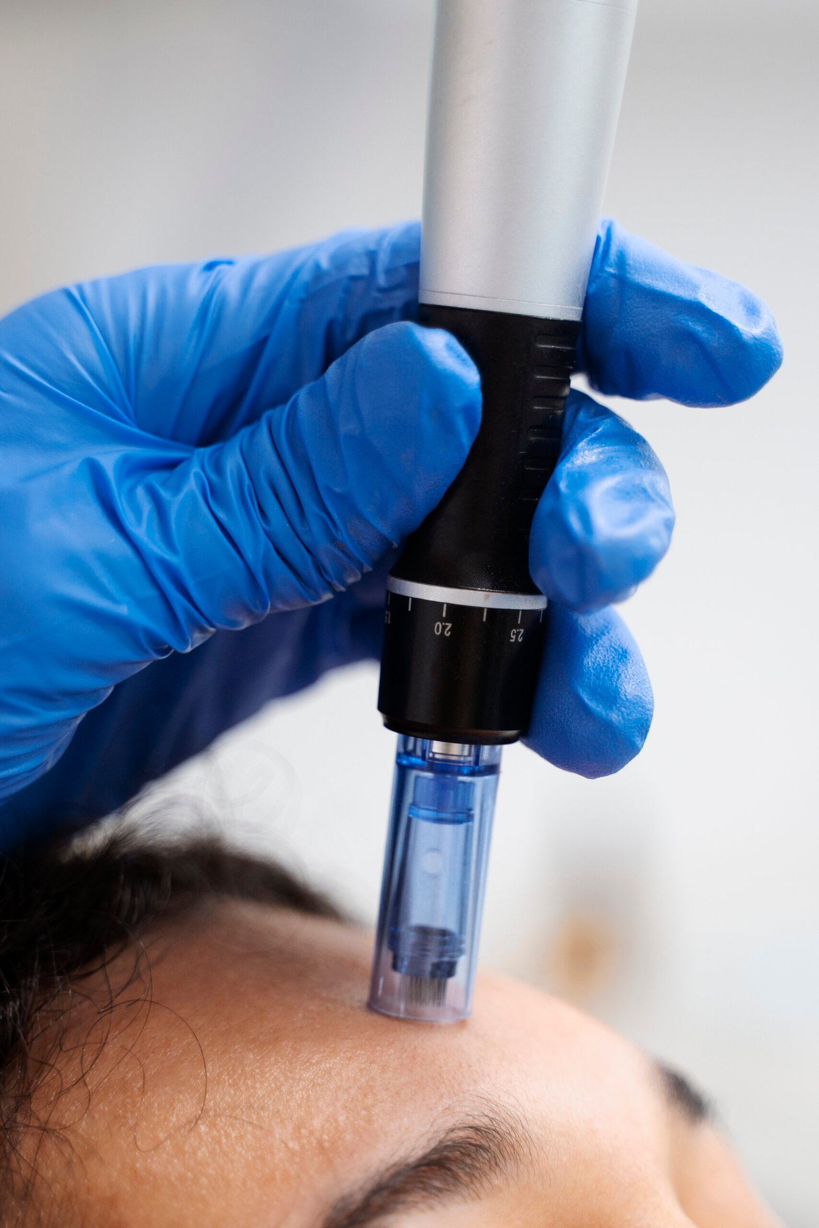 Skin Needling – Skin Radiance North Lakes