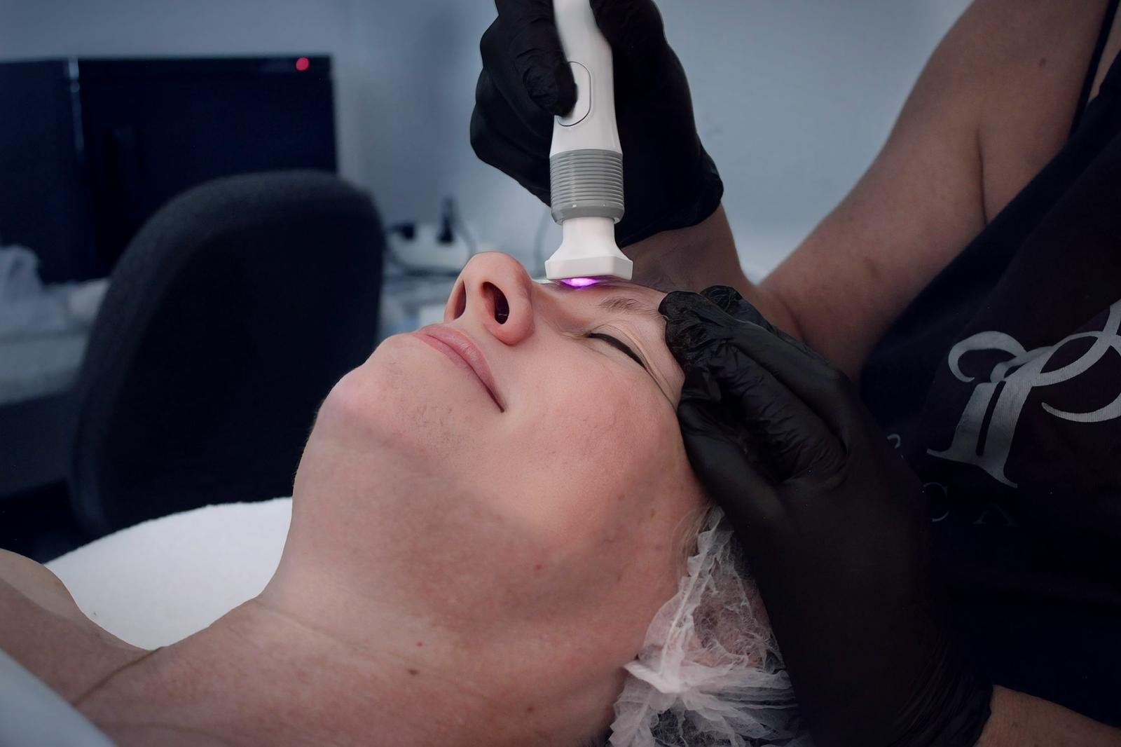 Jet Plasma Dotless Skin Rejuvenation – Skin Radiance North Lakes